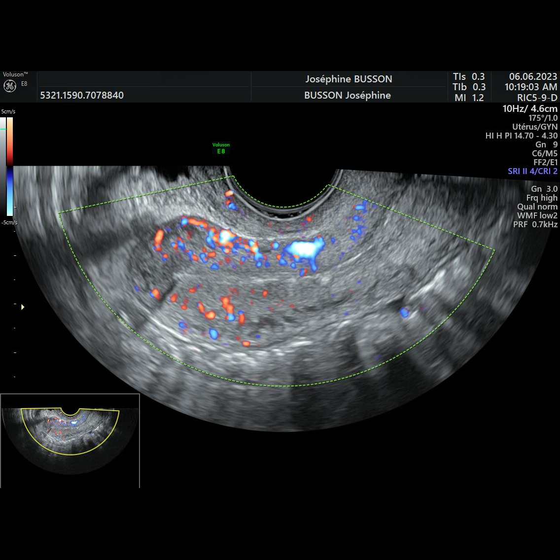 Place de l’échographie par voie vaginale en gynécologie et en ...